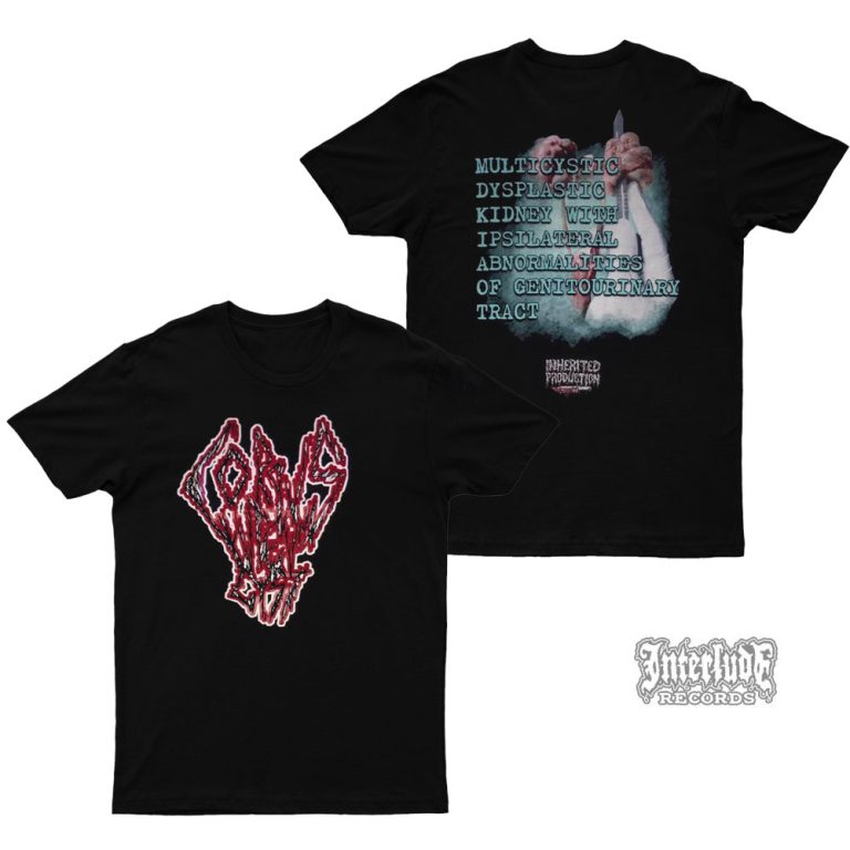 T-SHIRT – CORPUS LUTEUM CYST – Multicystic Dysplastic Kidney With ...